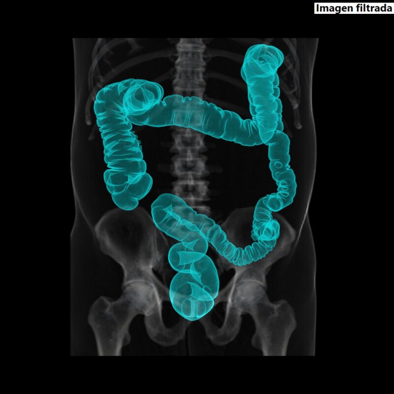 Colonoscopia Virtual por Tomografía Computarizada - Anato Imagen